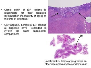 Endometrial hyperplasia | PPTX