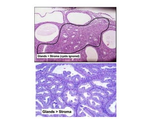 Endometrial hyperplasia | PPT