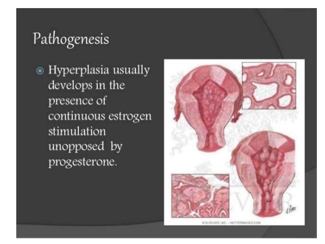 Endometrial hyperplasia