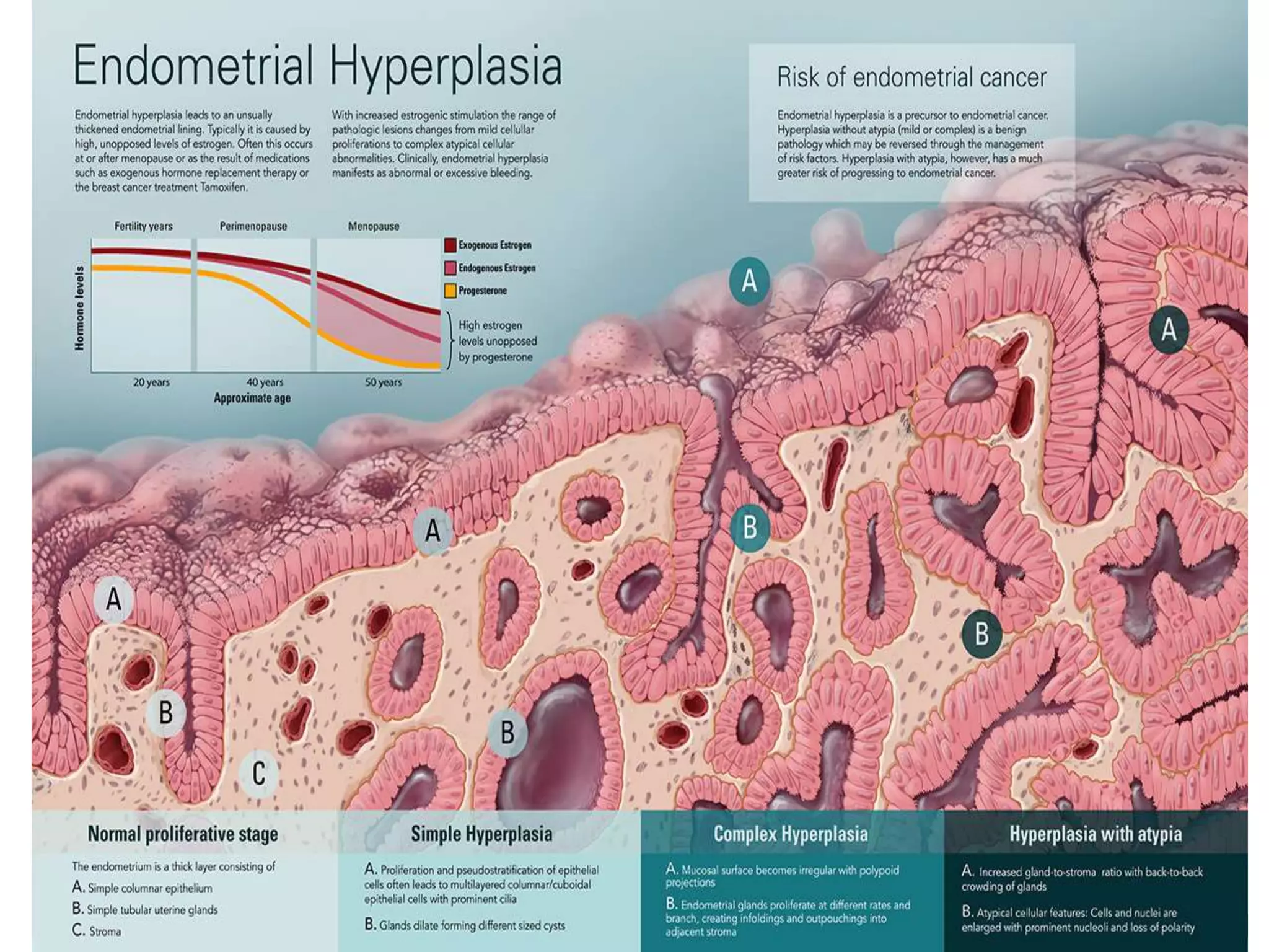 Endometrial hyperplasia | PPTX