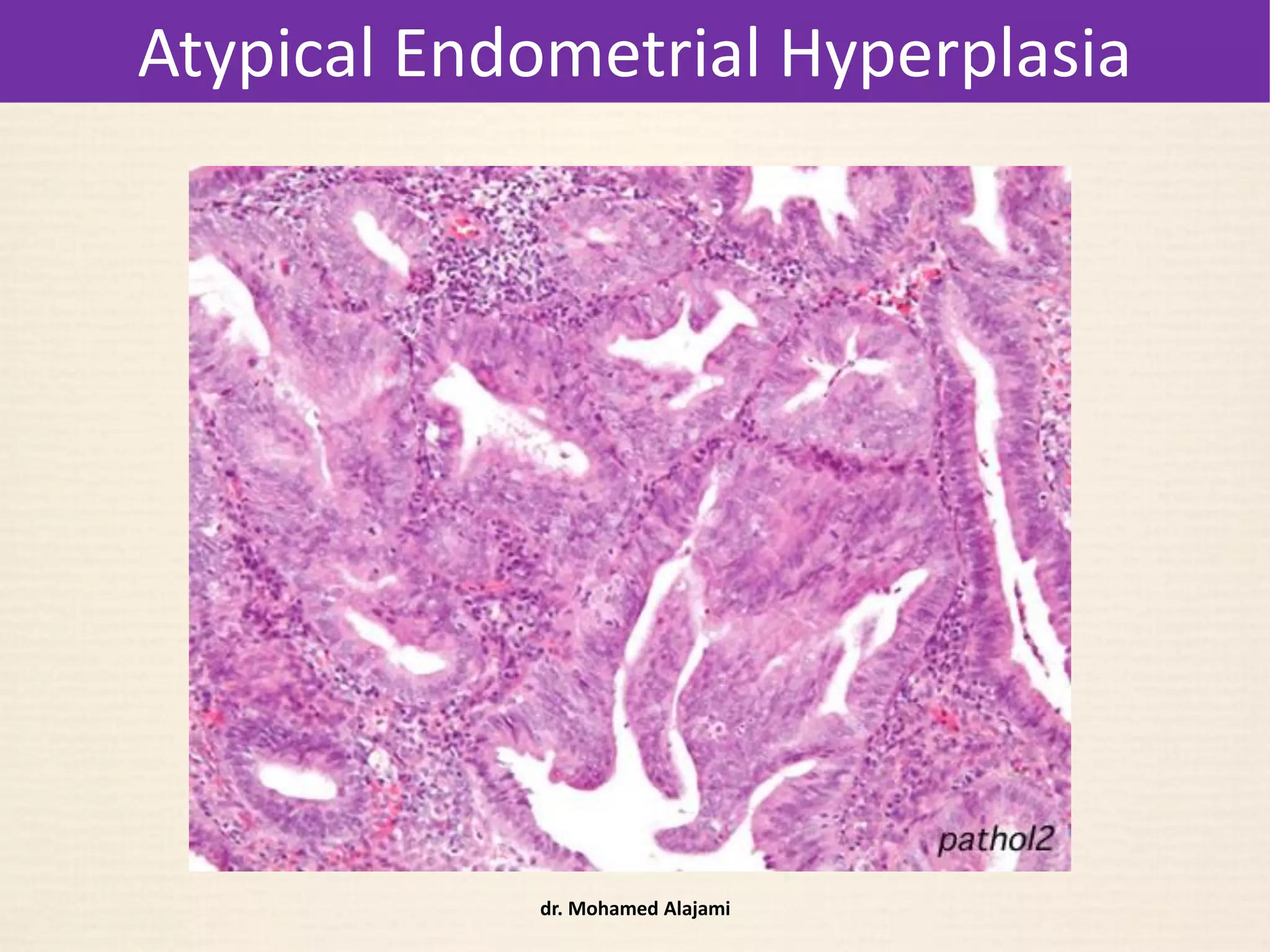 Endometrial hyperplasia dr.alajami | PDF | Menopause | Endocrine and Metabolic Diseases