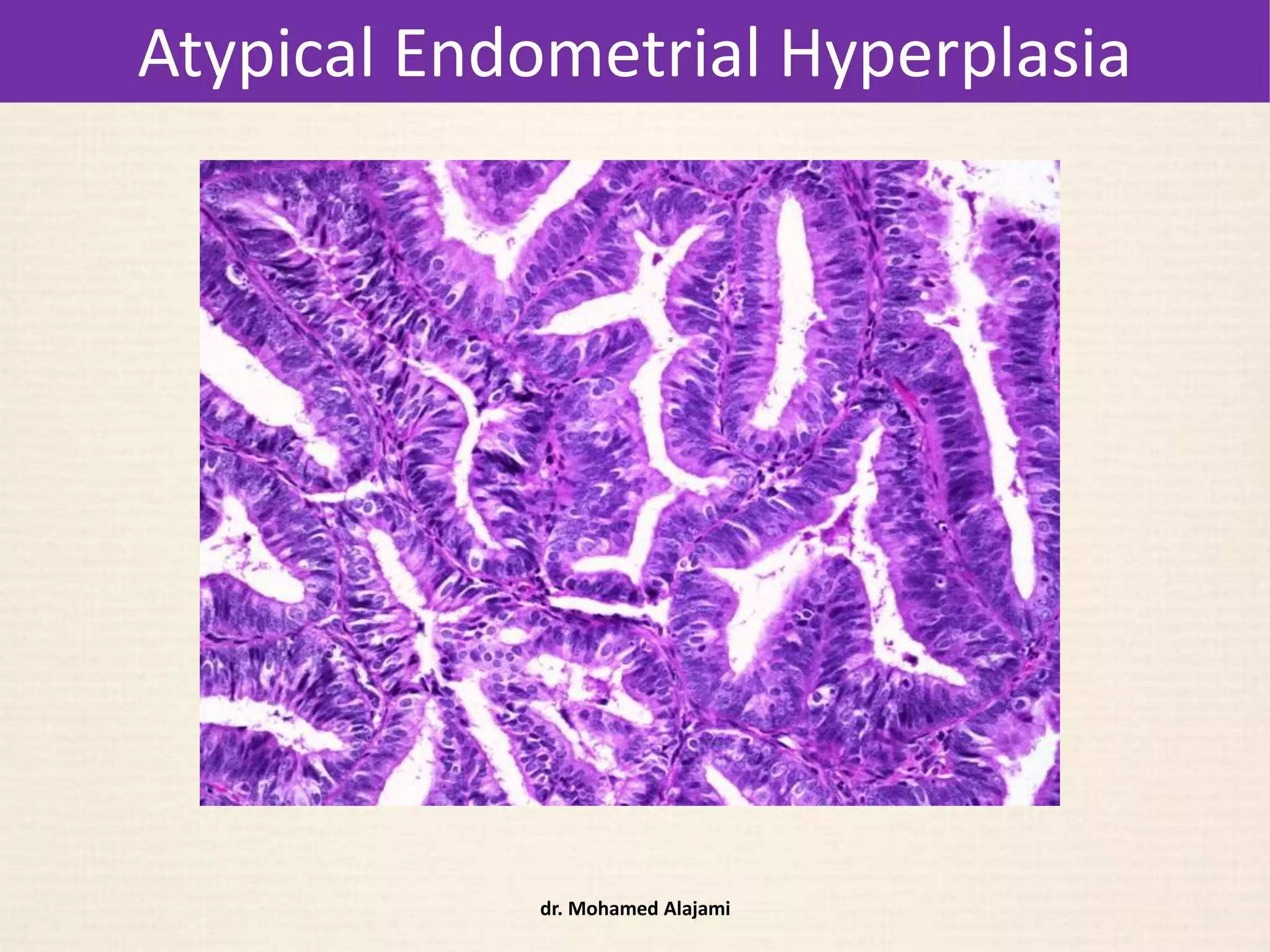 Endometrial hyperplasia dr.alajami | PDF | Menopause | Endocrine and Metabolic Diseases