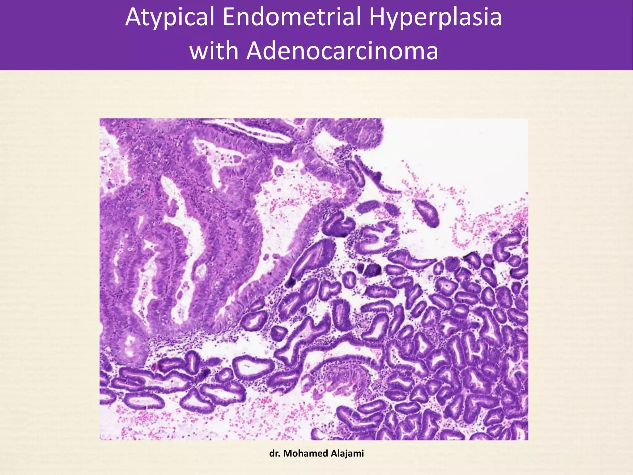 Endometrial hyperplasia dr.alajami | PDF | Menopause | Endocrine and Metabolic Diseases