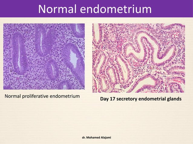 Endometrial hyperplasia dr.alajami | PDF | Menopause | Endocrine and ...