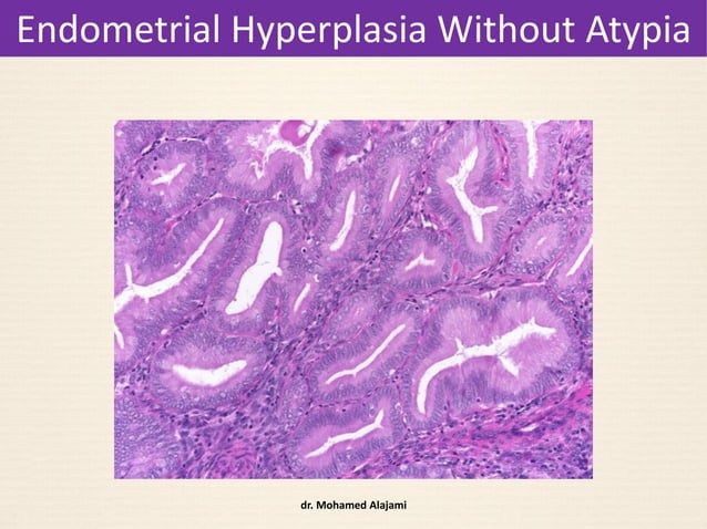 Endometrial hyperplasia dr.alajami | PDF | Menopause | Endocrine and Metabolic Diseases