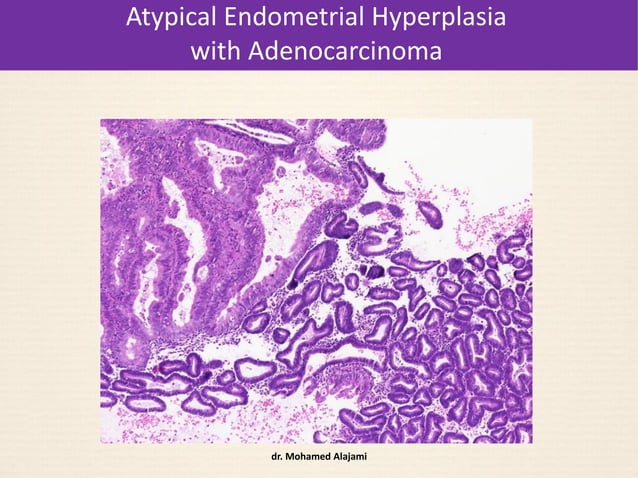 Endometrial hyperplasia dr.alajami | PDF | Menopause | Endocrine and Metabolic Diseases