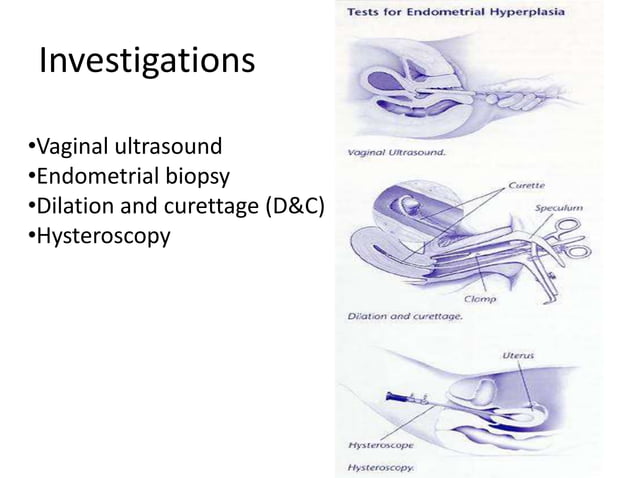 Endometrial hyperplasia.ppt | Menopause | Endocrine and Metabolic Diseases