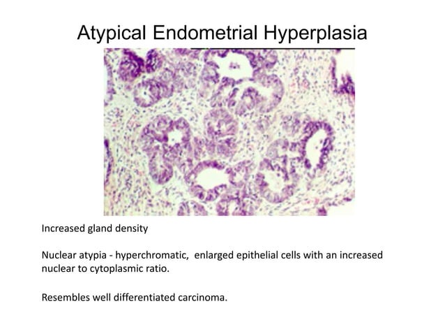 Endometrial hyperplasia.ppt | Menopause | Endocrine and Metabolic Diseases