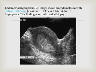 Endometrial pathologies | PPT