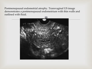 The Fluid In Uterine Cavity