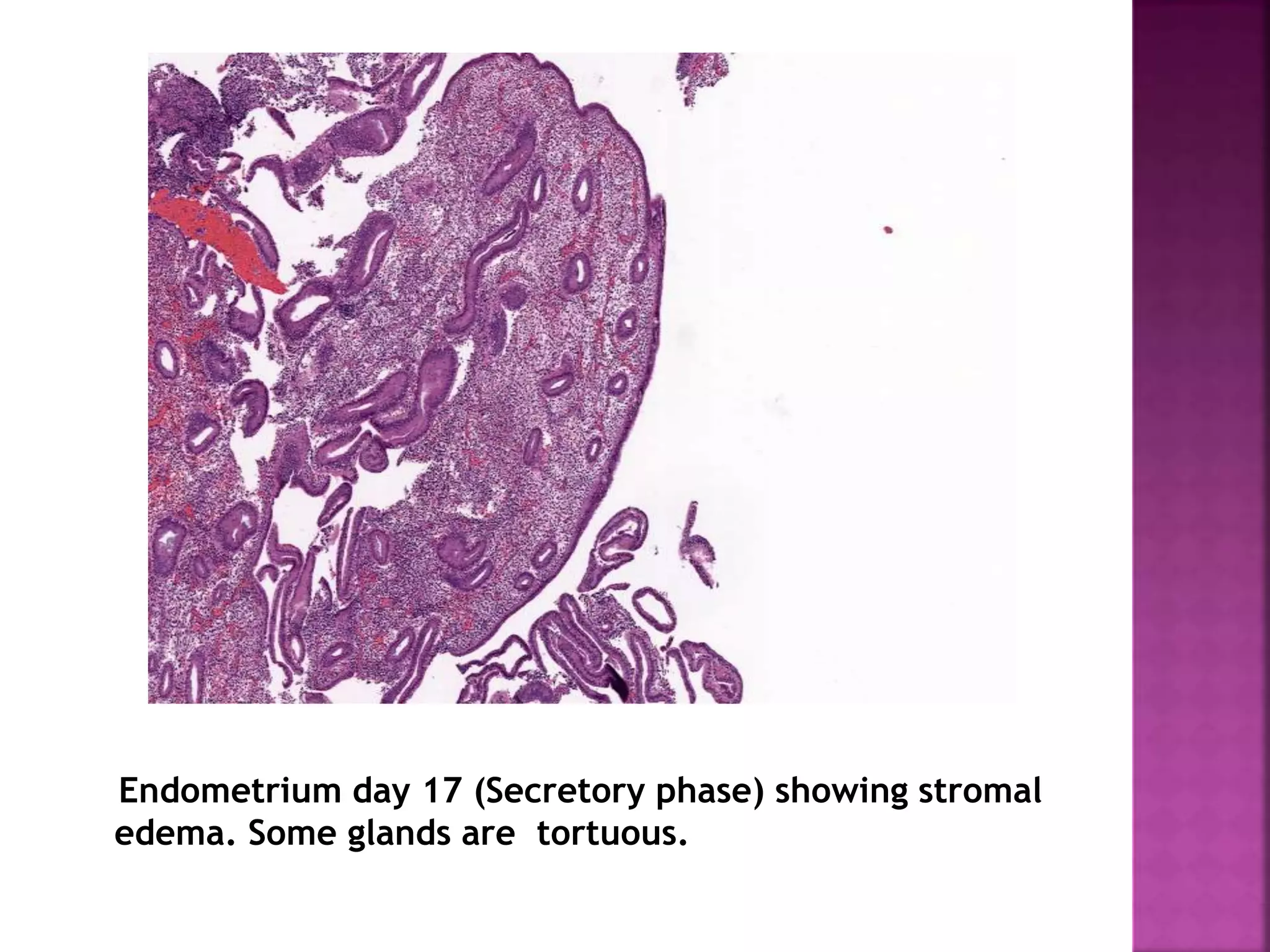 endometrium pathology | PPTX
