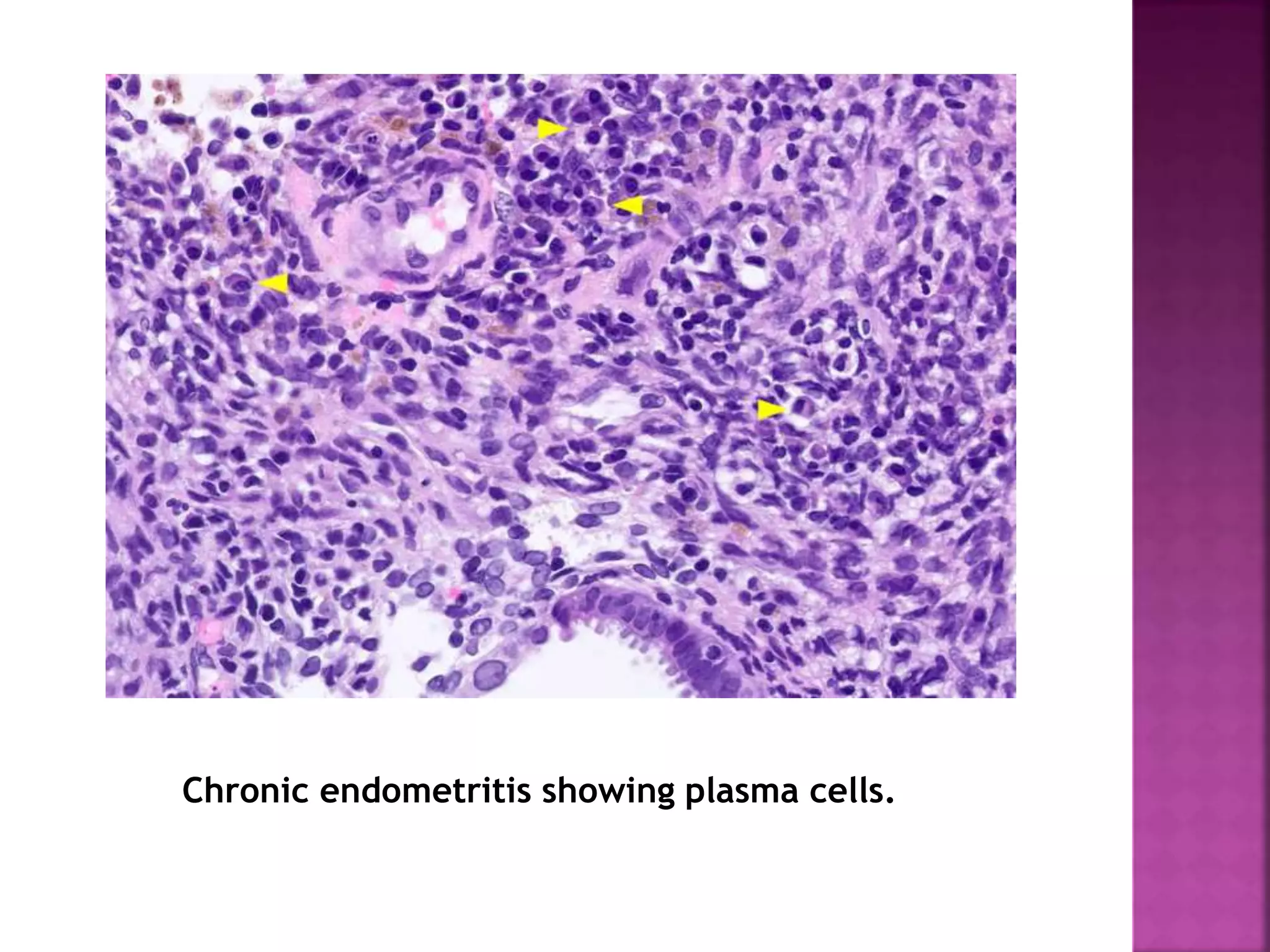 endometrium pathology | PPTX