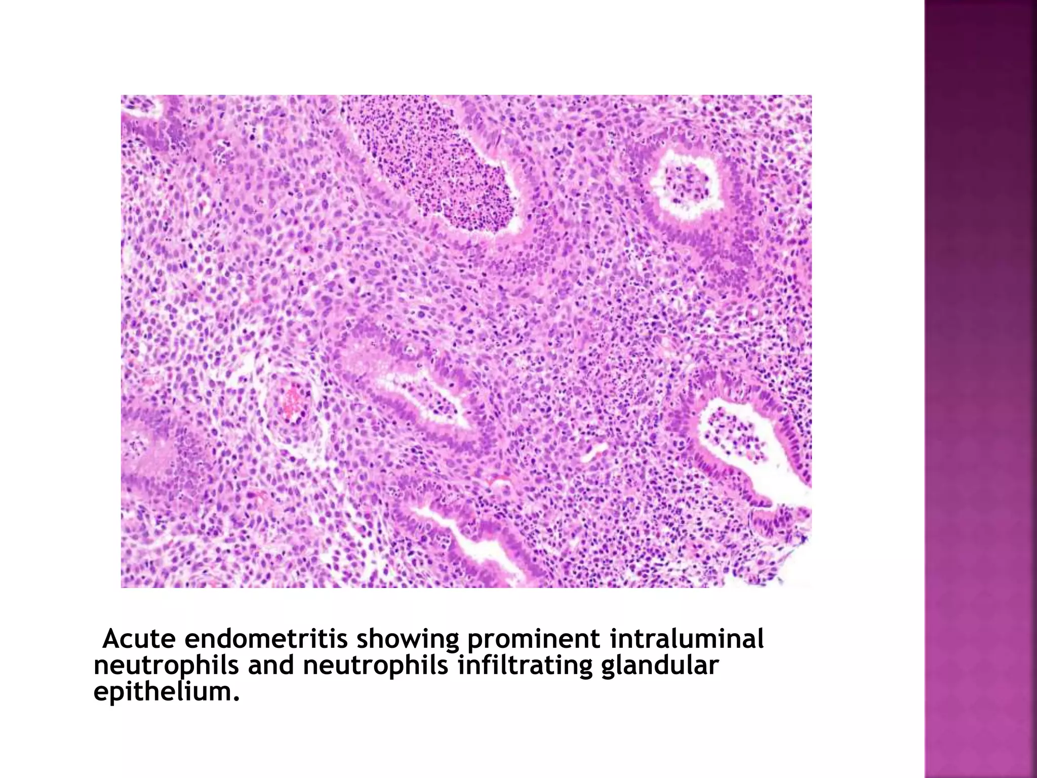 endometrium pathology | PPTX