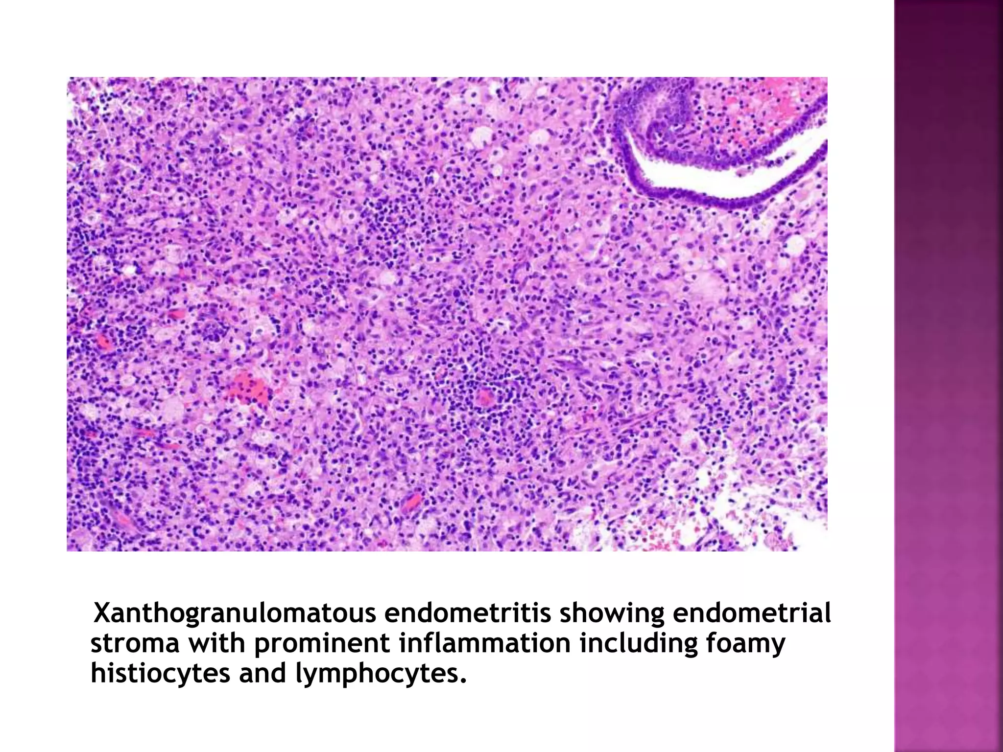 endometrium pathology | PPTX