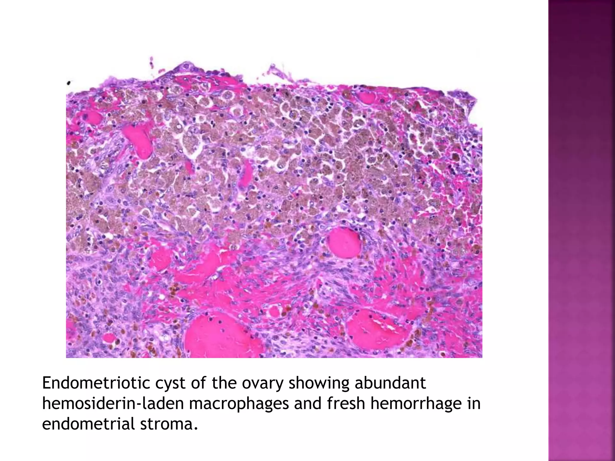 endometrium pathology | PPTX