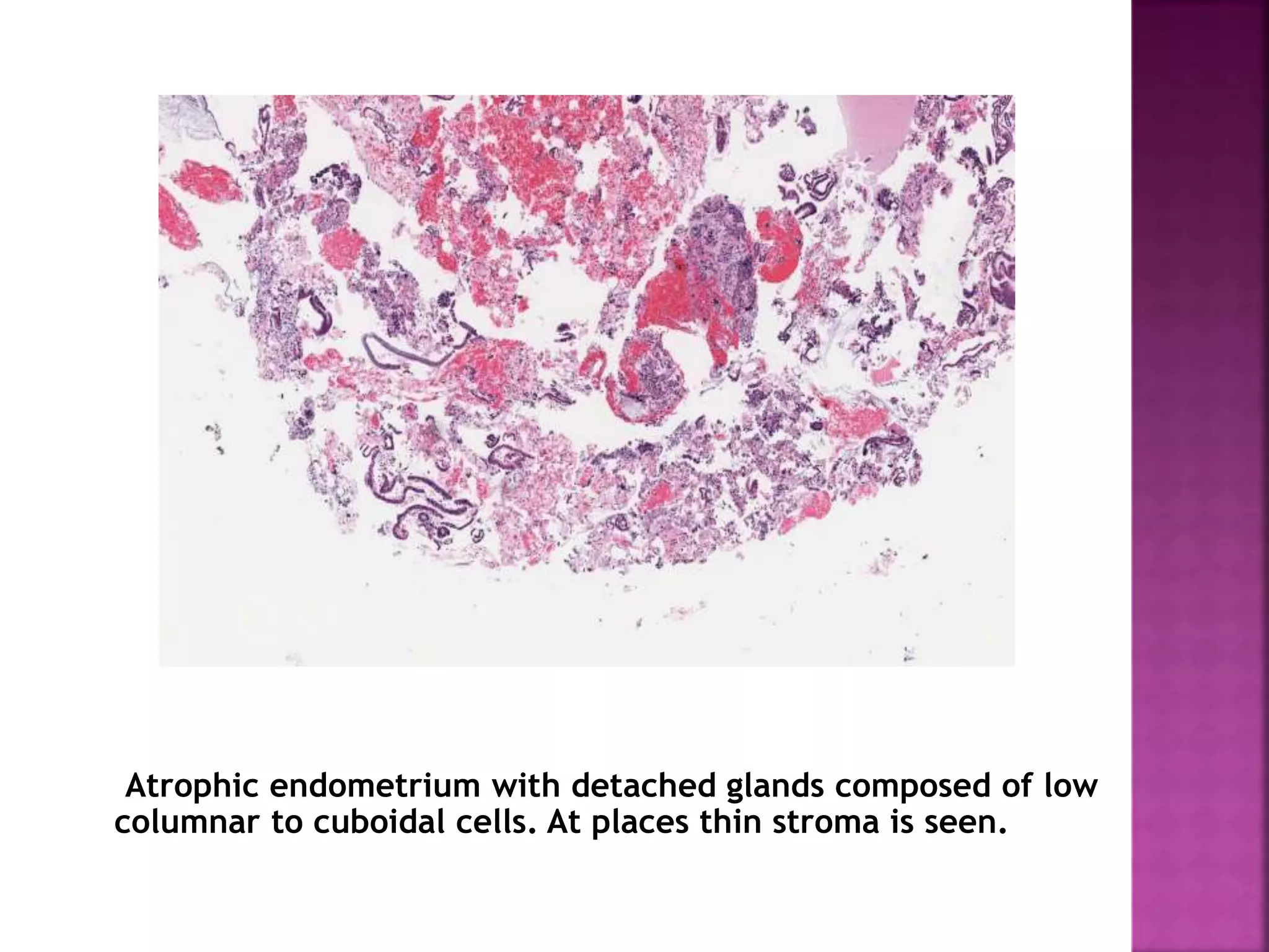 endometrium pathology | PPTX