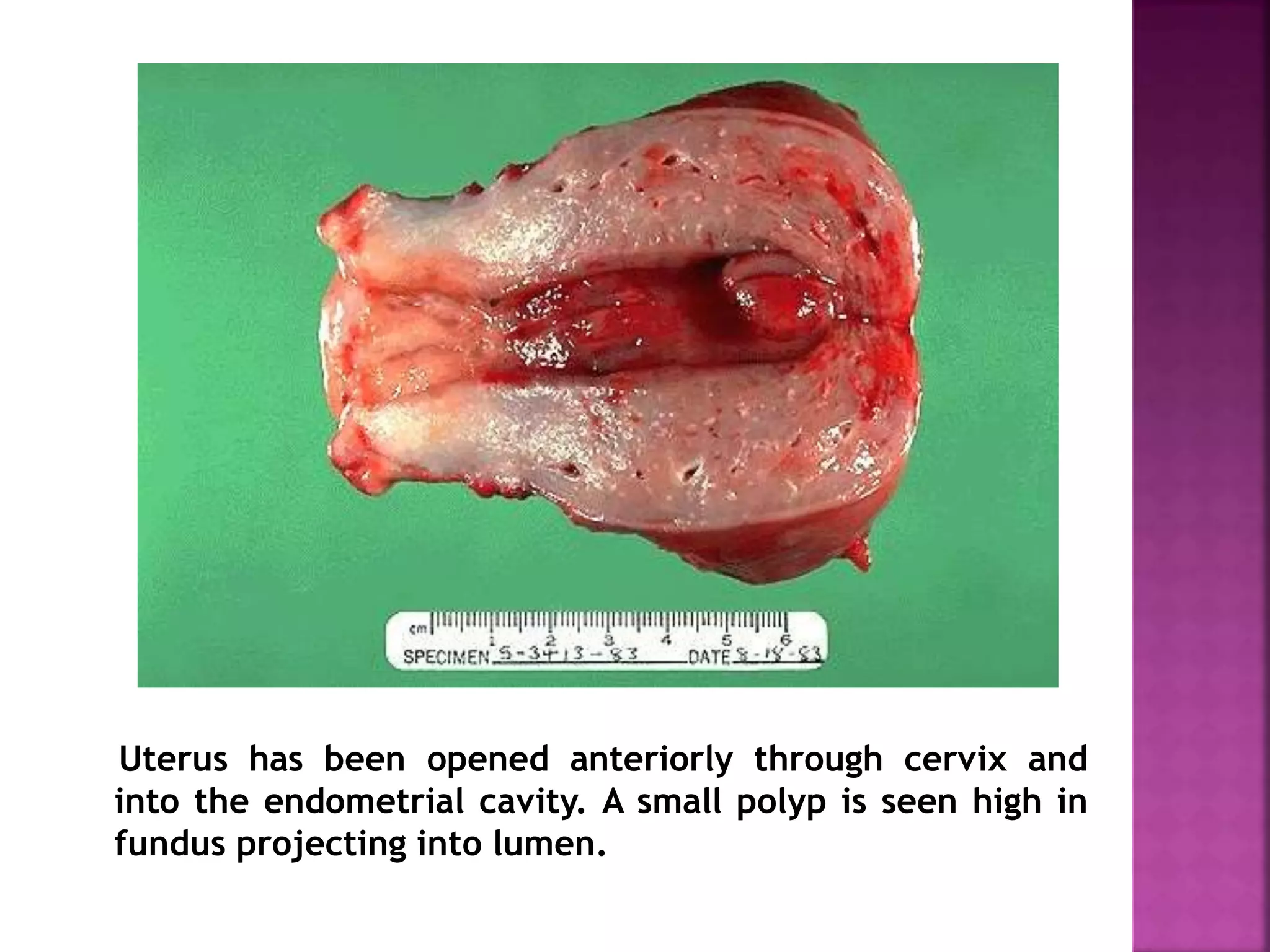endometrium pathology | PPTX