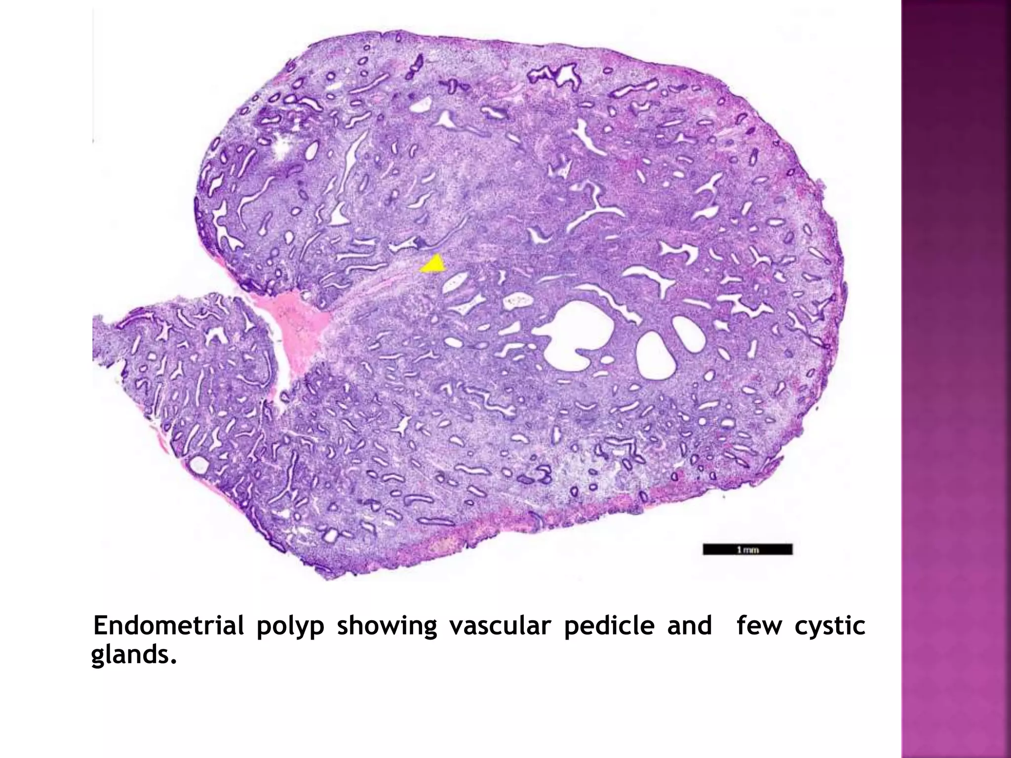 endometrium pathology | PPTX