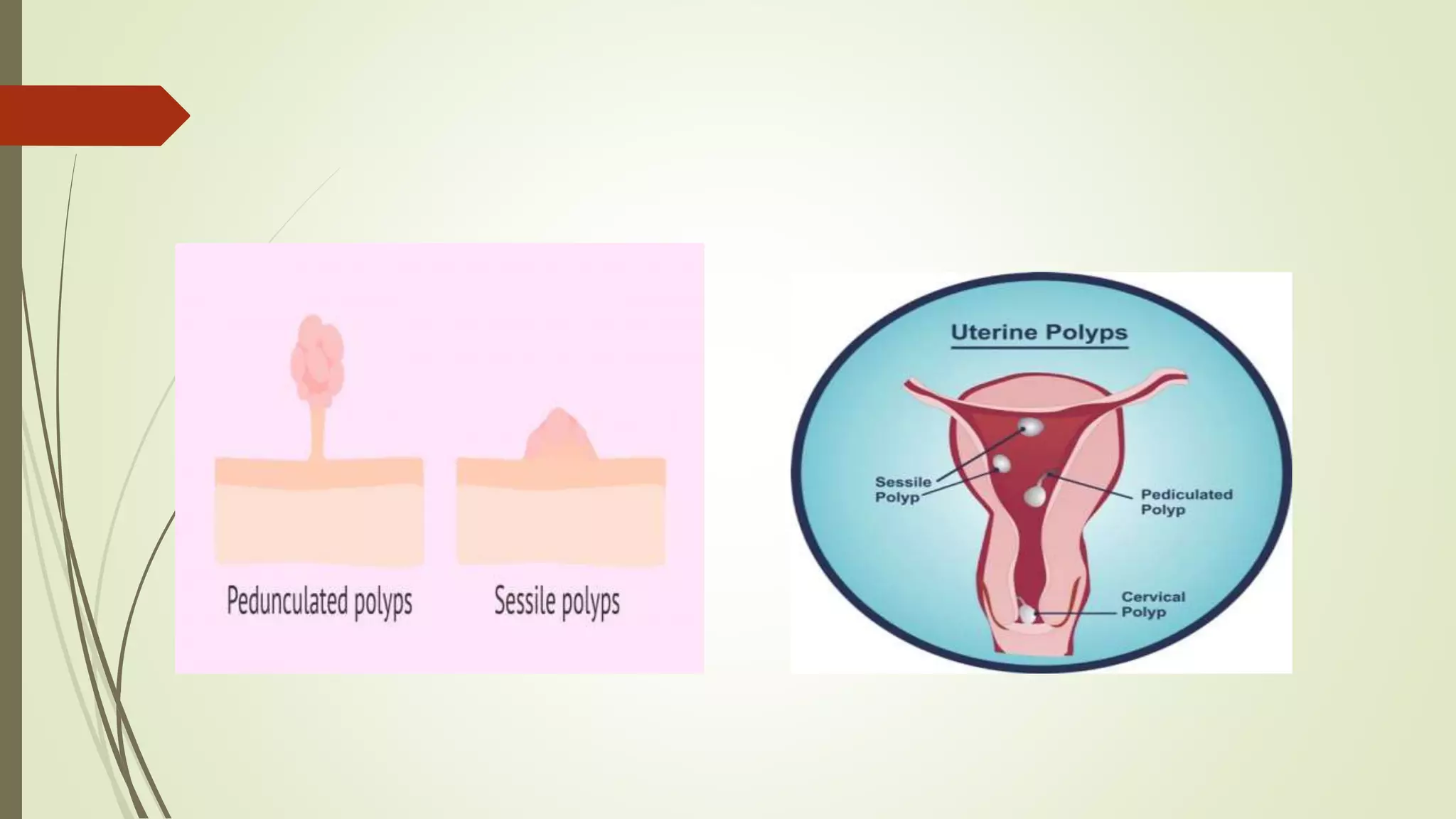 Endometrial polyp | PPTX