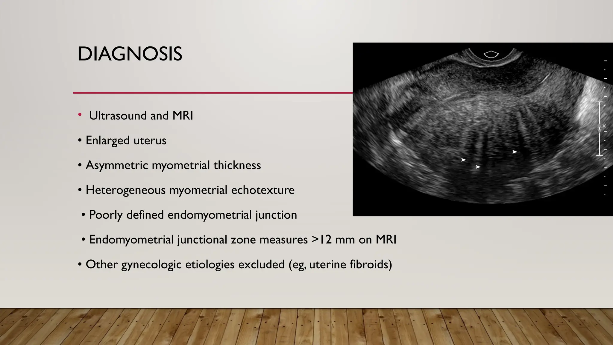 ENDOMETRIAL POLYP and ADENOMYOSIS GAKO.pptx