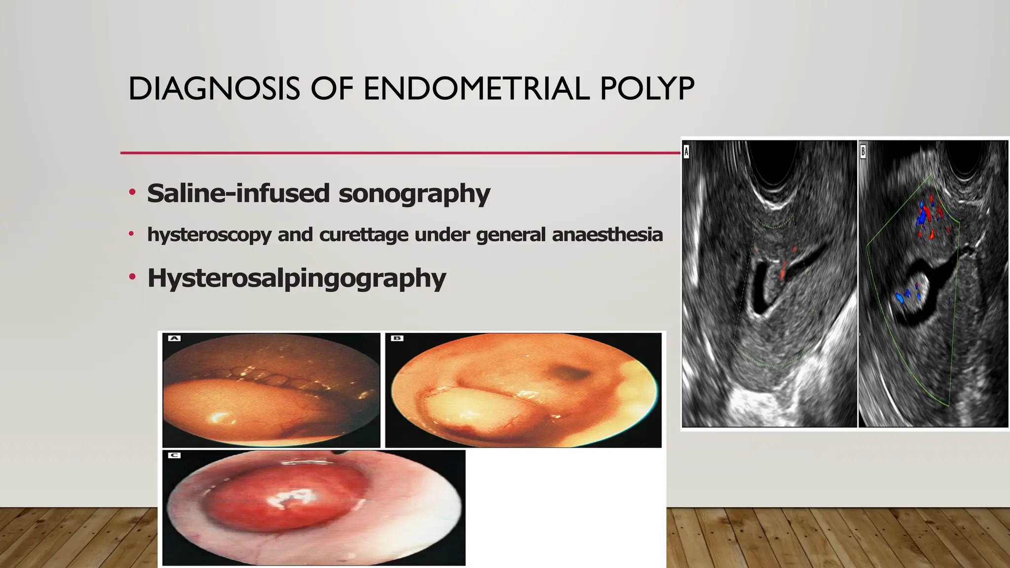 ENDOMETRIAL POLYP and ADENOMYOSIS GAKO.pptx