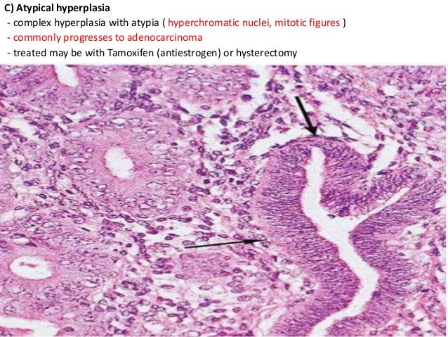 Endometrial Polyp Hyperplasia Carcinoma
