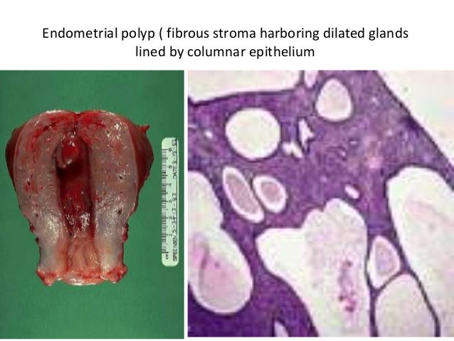 Endometrial polyp, hyperplasia, carcinoma