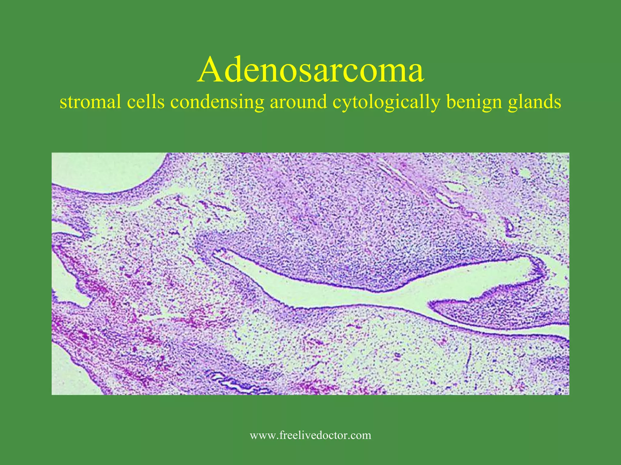 Endometrial polyps | PPT