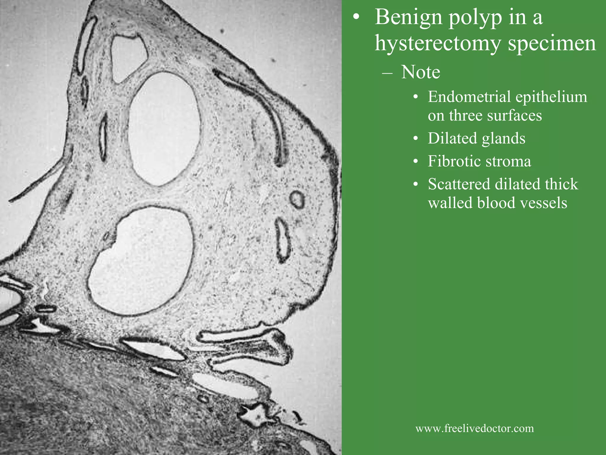 Endometrial polyps | PPT