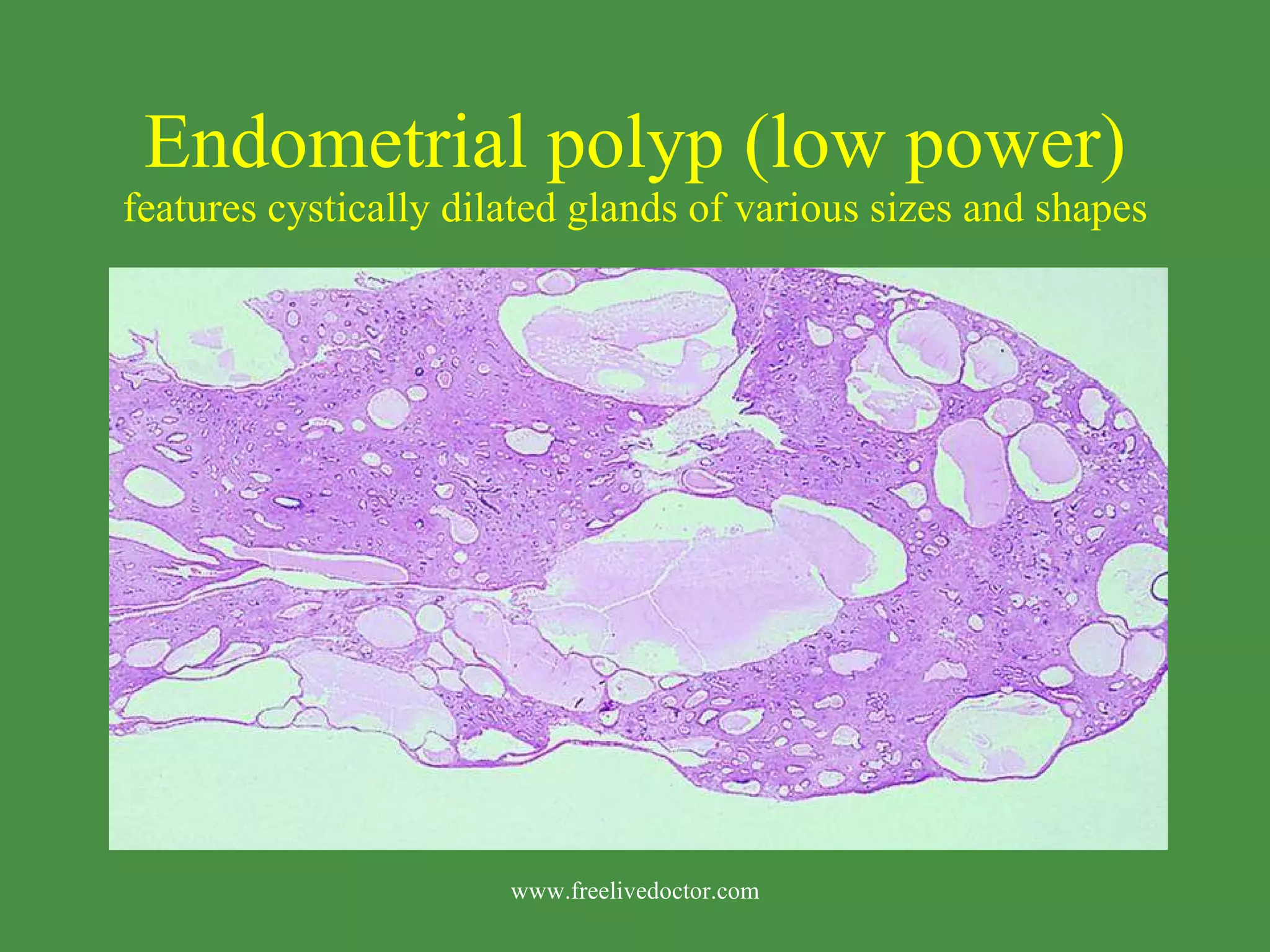 Endometrial polyps | PPT