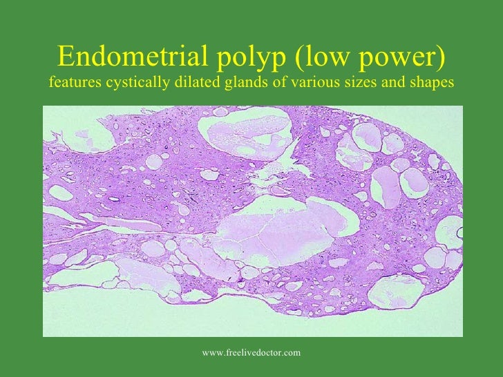Endometrial Polyp Removal