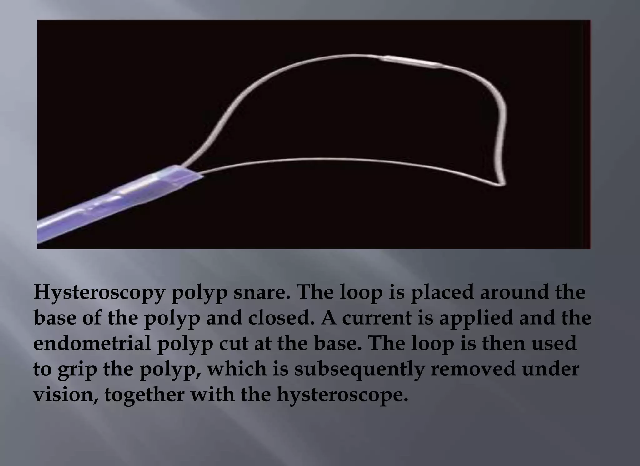 The management of endometrial polyps in the 21st century | PPTX