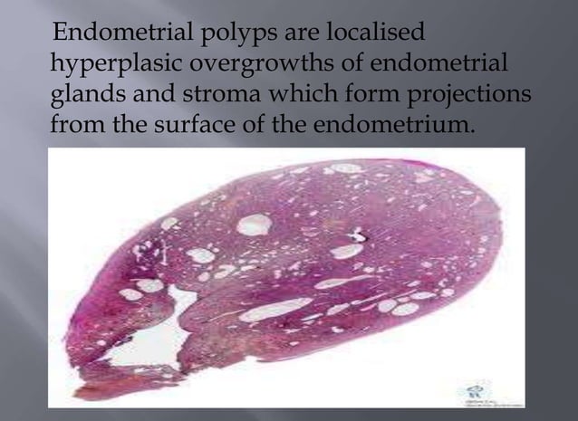 The management of endometrial polyps in the 21st century | PPTX
