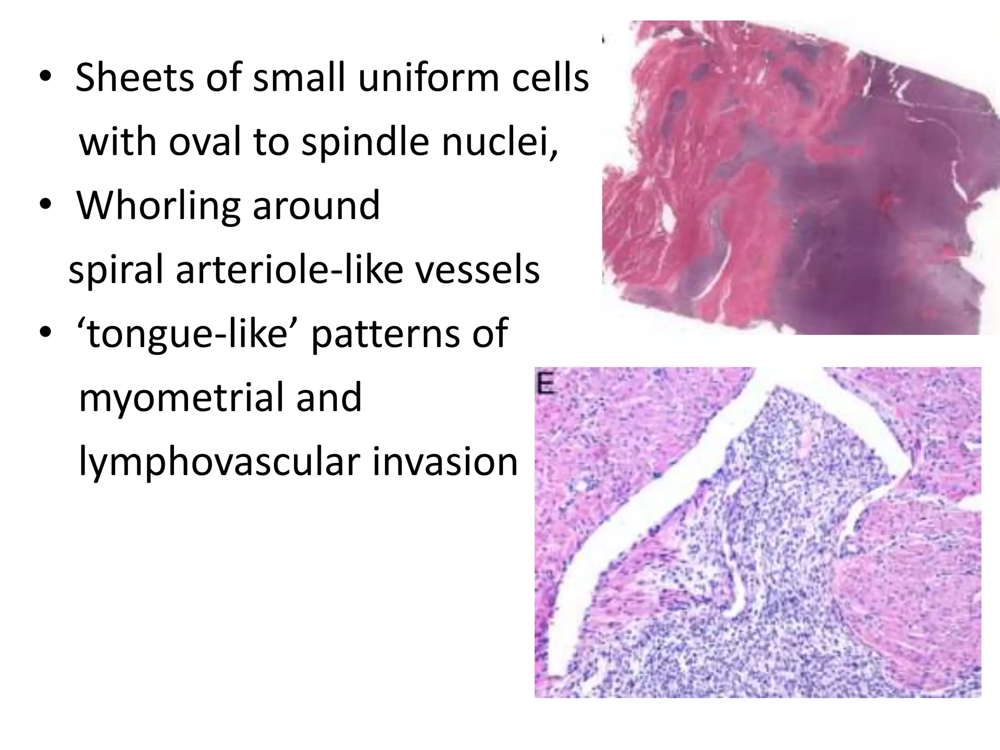 Endometrial stromal tumours revisited | PPTX