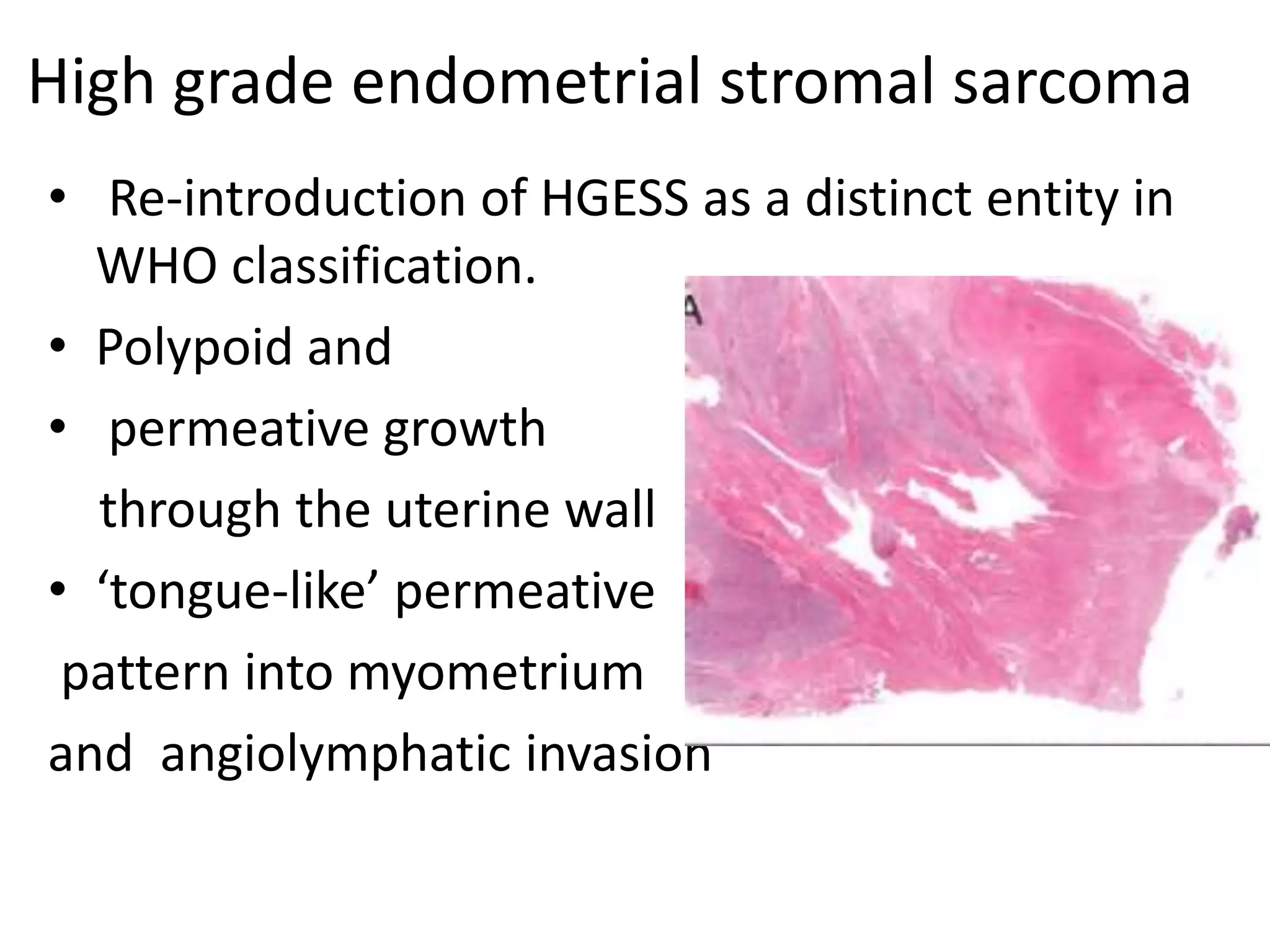 Endometrial stromal tumours revisited | PPTX