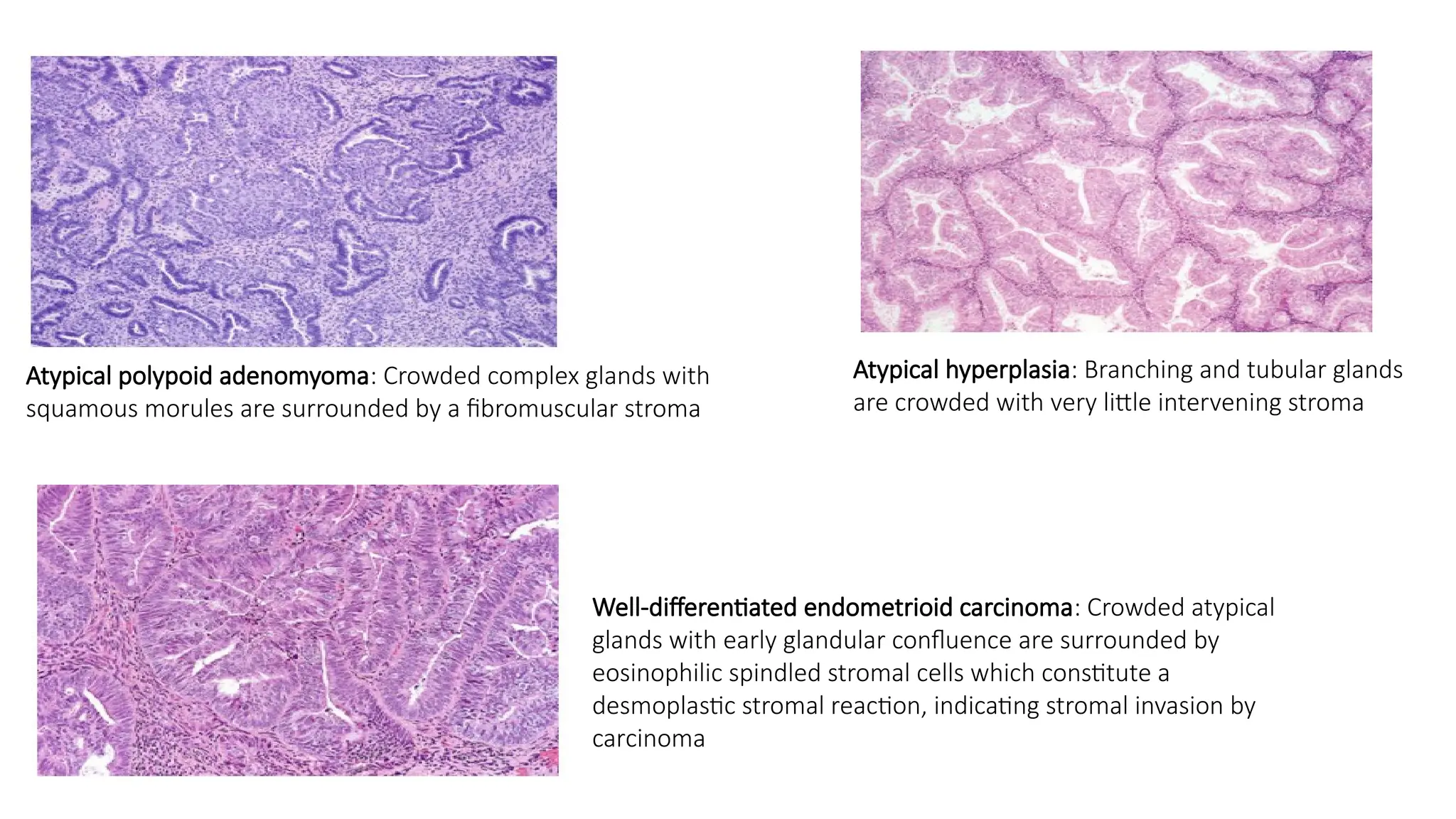 ENDOMETRIAL TUMOUR NEW.pptx download ppt | PPTX