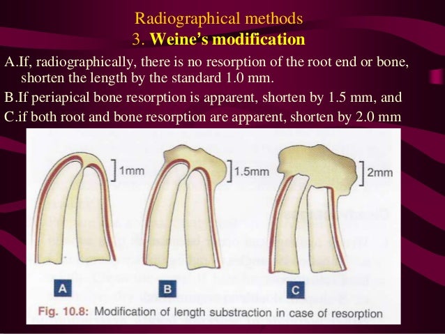 working length estimation in endodontic