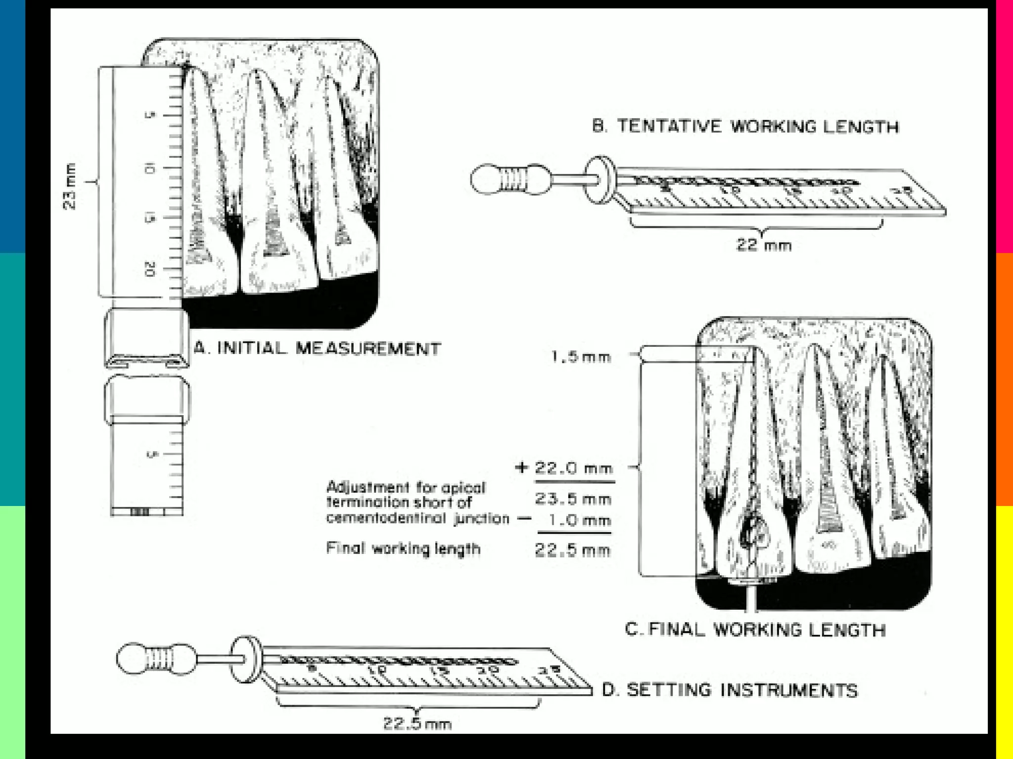 Endometrics Root Canal Working Length Determination Ppt