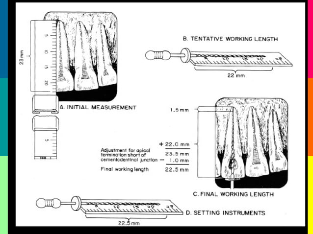 Endometrics root canal working length determination | PPT | Dental ...