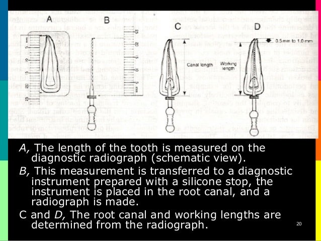 Endometrics root canal working length determination