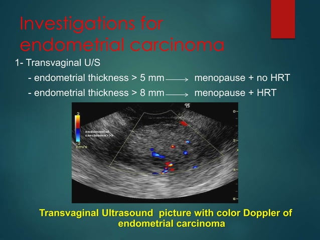 Endometril carcinoma | PPT
