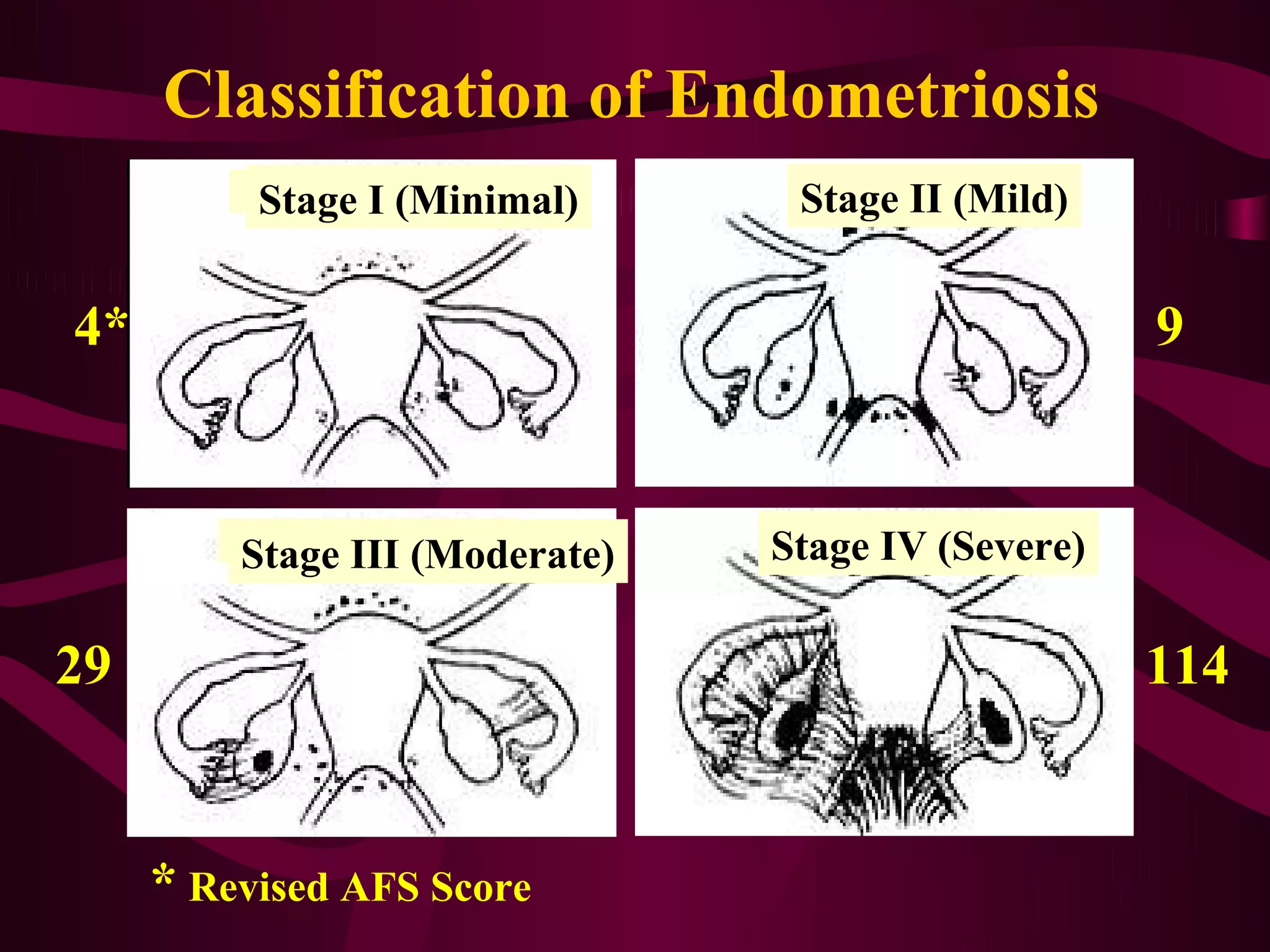 Endometriosis | PPT