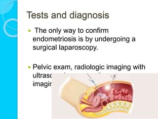 Endometriosis | PPTX | Pregnancy | Reproductive Health