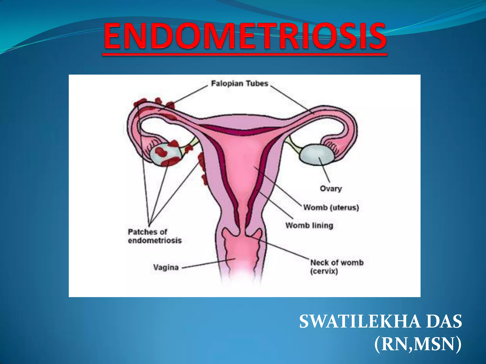Endometriosis- Easy explanation with Management... | PDF