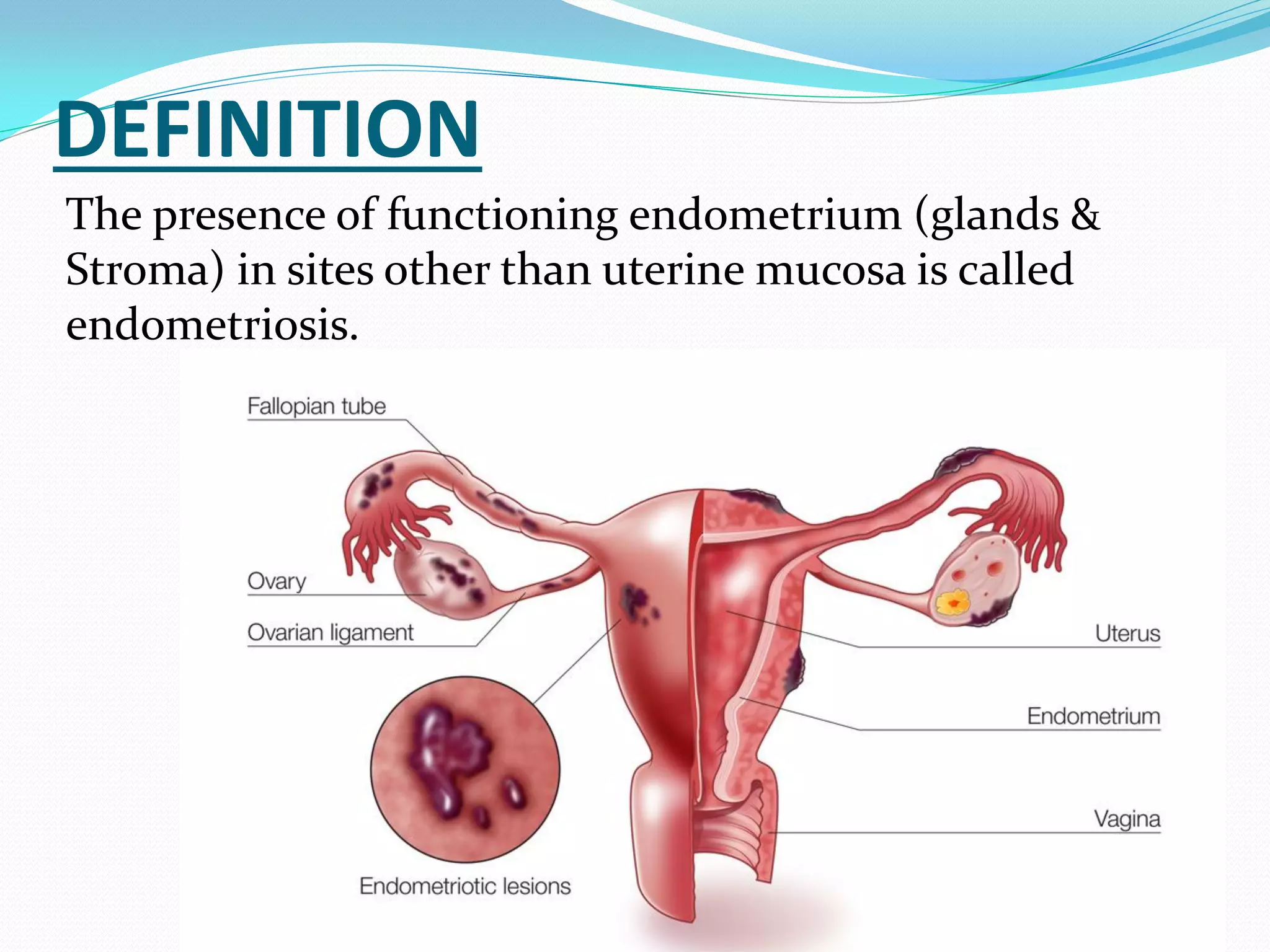 Endometriosis- Easy explanation with Management... | PDF