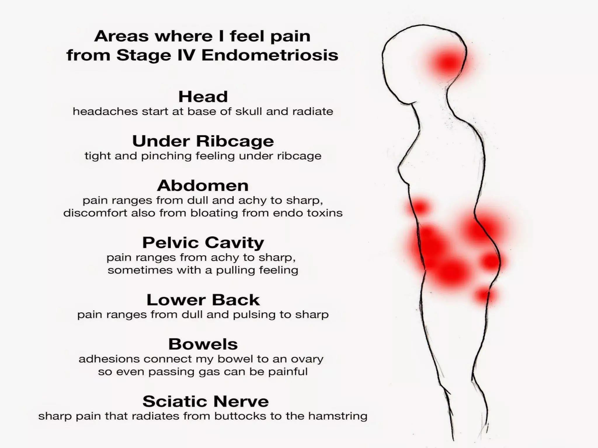 Endometriosis- Easy explanation with Management... | PDF