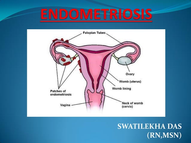 Endometriosis- Easy explanation with Management... | PDF