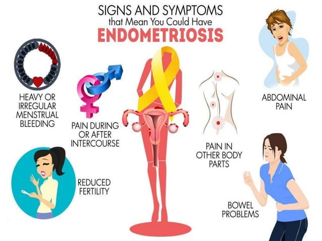 Endometriosis- Easy explanation with Management... | PDF