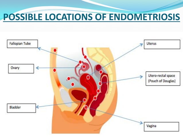 Endometriosis- Easy explanation with Management... | PDF