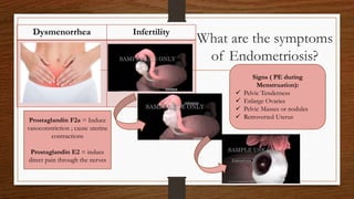 Endometriosis | PPTX